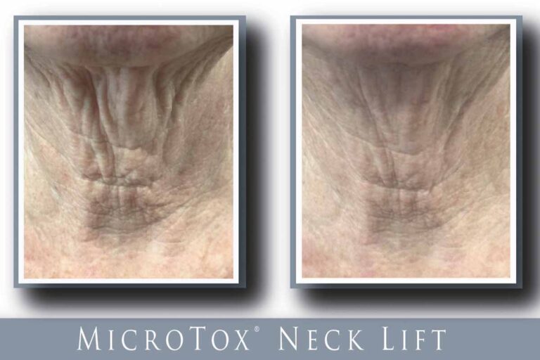 MicroTox® in Encinitas | Aesthetically Pleasing Medical Spa
